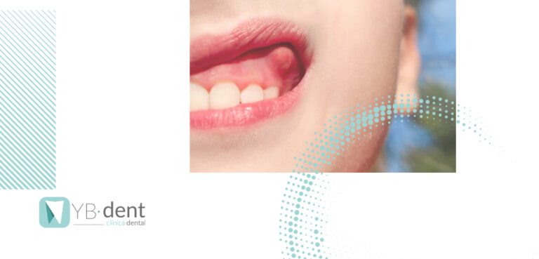 ¿Qué es un absceso periapical y cómo tratarlo? Clínica YBdent