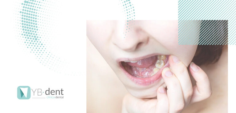 Cómo identificar las muelas cariadas y cómo tratarlas